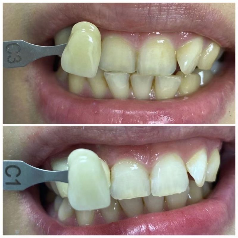 New Teeth Whitening Promotion COMBO!